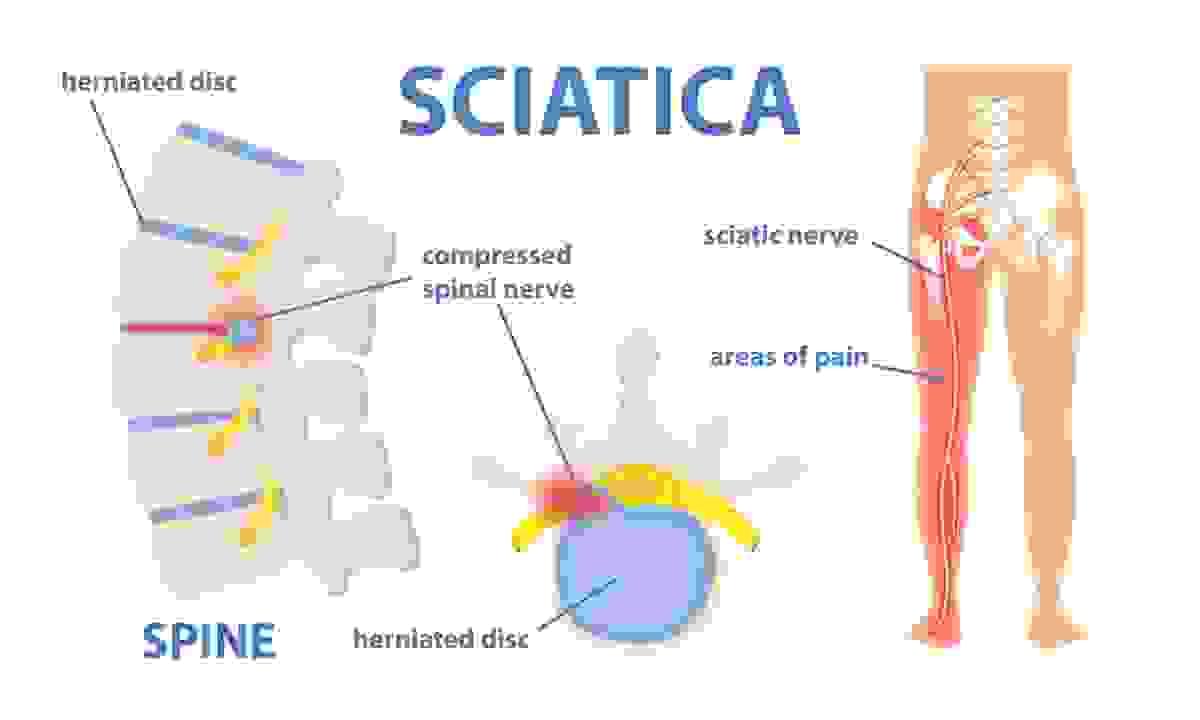 Sciatica: Symptoms, Causes, and Treatment Options in Mu...