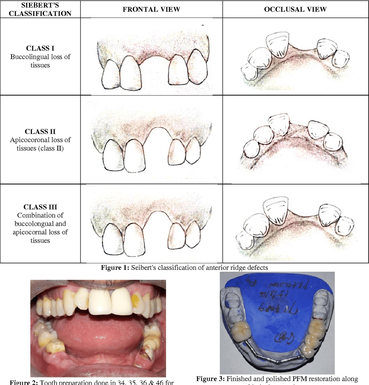 Siebert classification edentulous ridge