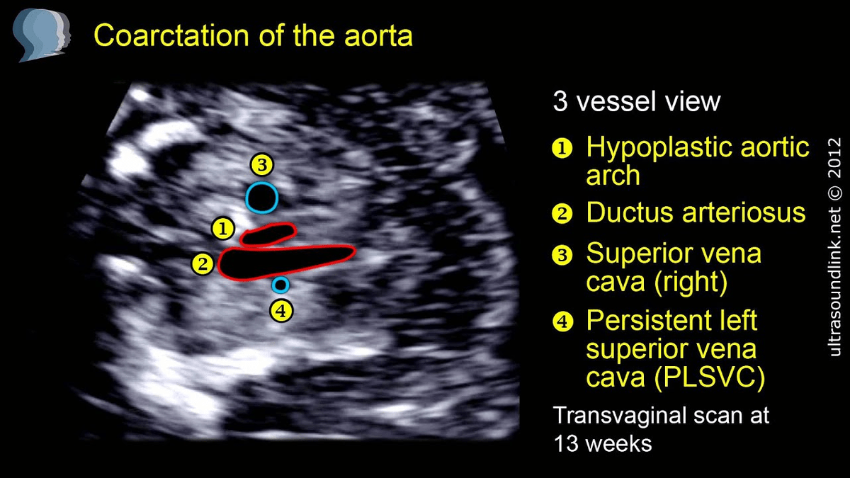 How does aortic coarctation cause radiofemoral delay