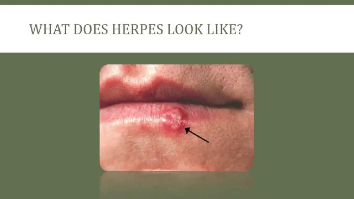 Can i get herpes by touching someone