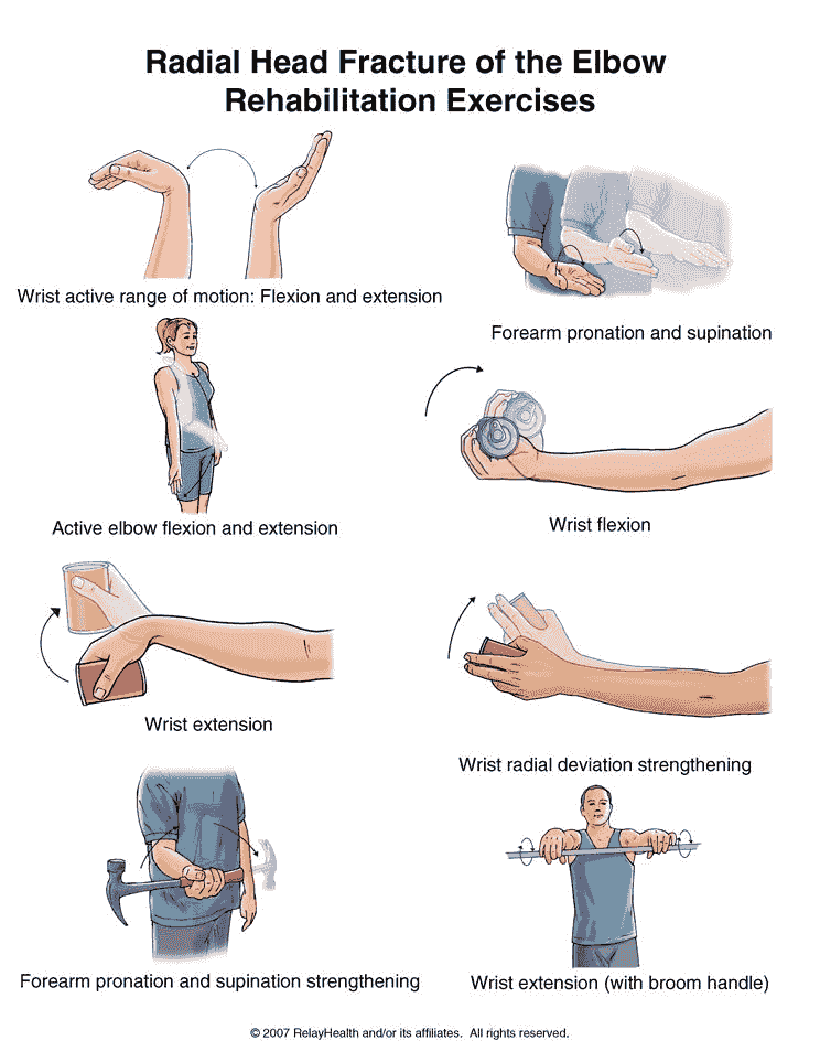 Humerus fracture surgery plate recovery time