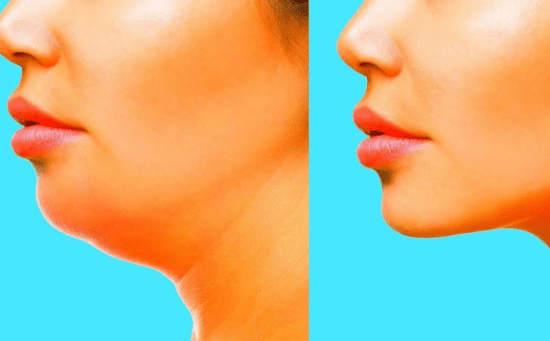 How to Get Rid Flabby Cheeks - Flabby Cheeks