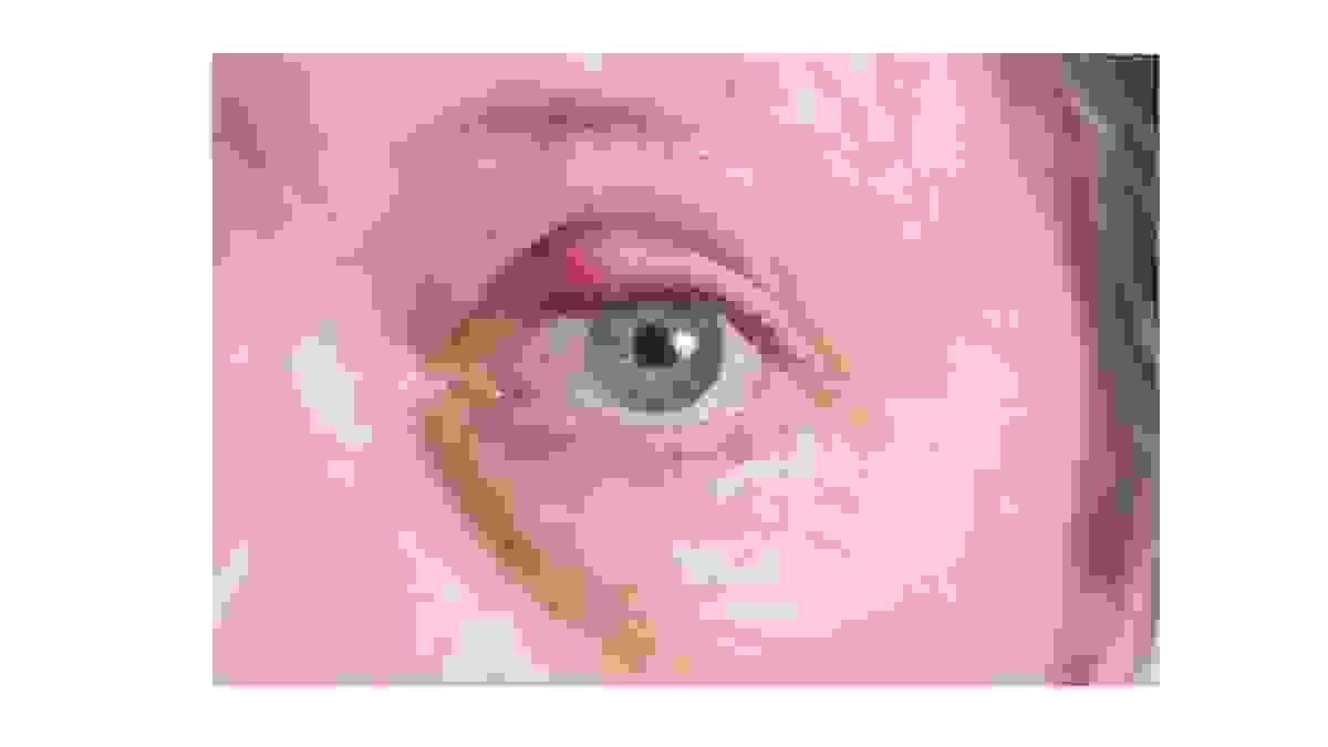 How To Get Rid of a Stye Overnight