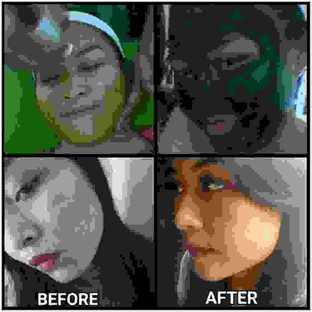 Penyebab Jerawat di Pipi dan Obat Masker Jerawat Ampuh