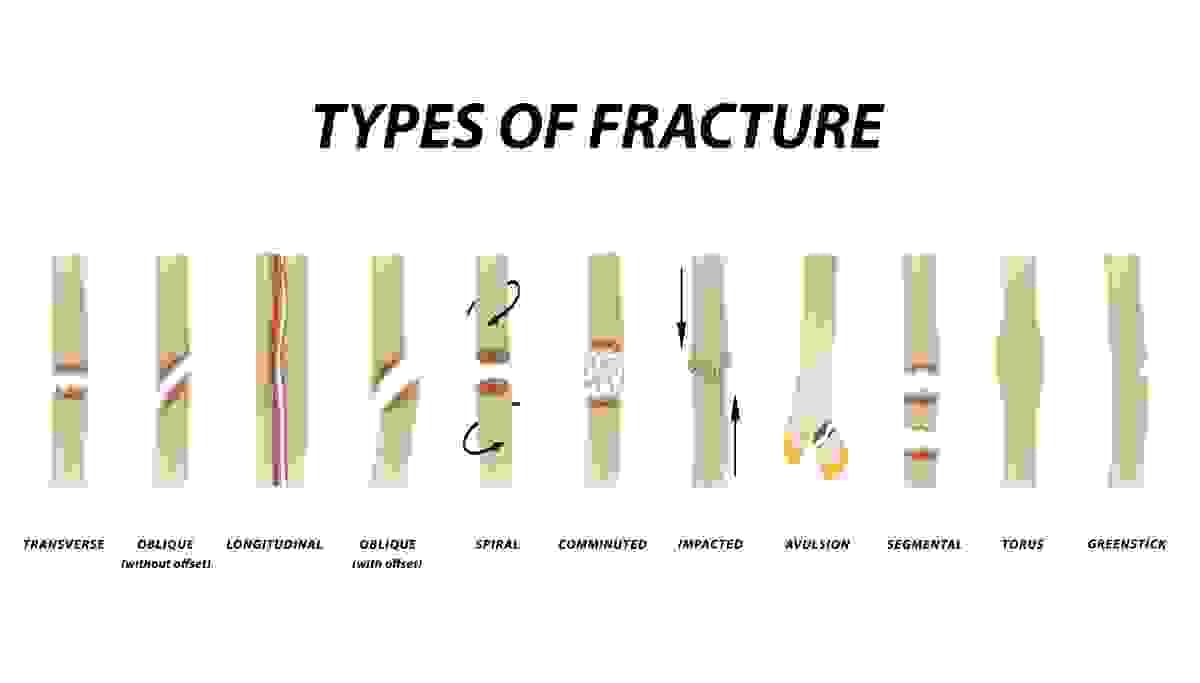 4 Common Types Of Fractures - orthopedics fractures bon...