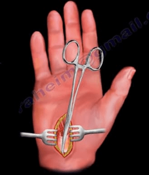 Compartment Syndrome of the Hand and Finger - hand Orth...