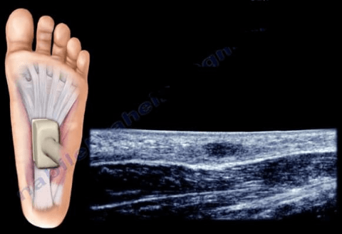 Plantar Fascia-Fibromatosis - Foot pain Plantar fasciit...