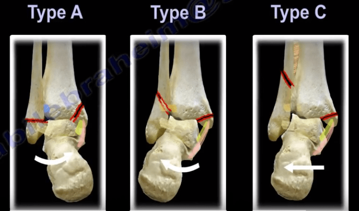 Ankle Fractures - Ankle Nabil Ebraheim Orthopedics Heal...