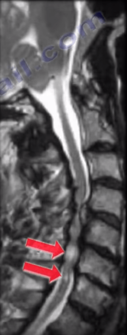 Cervical Myelopathy - Healthcare Nabil Ebraheim Orthope...