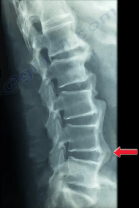Diffuse Idiopathic Skeletal Hyperostosis - DISH Orthope...
