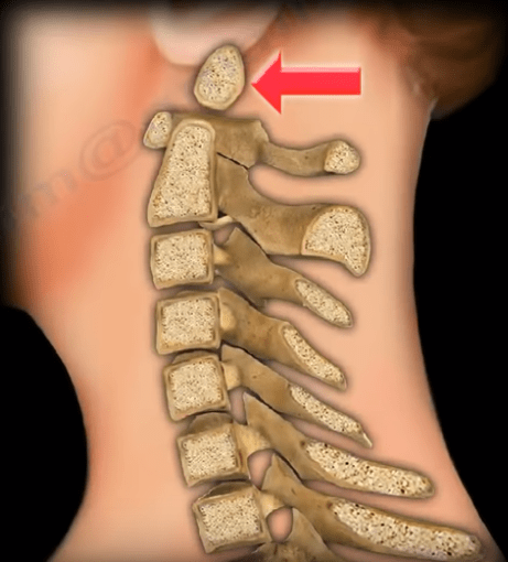 Odontoid Fractures - Healthcare Orthopedics Spine Fract...