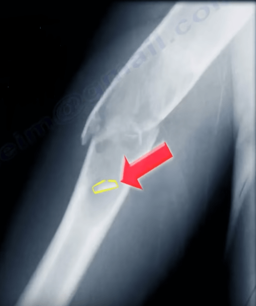 Unicameral Bone Cyst - Healthcare Orthopaedics Lesions ...