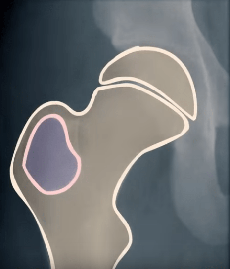 Unicameral Bone Cyst - Healthcare Orthopaedics Lesions ...