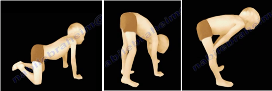 Gowers' Sign - Healthcare doctor Orthopedic Surgery