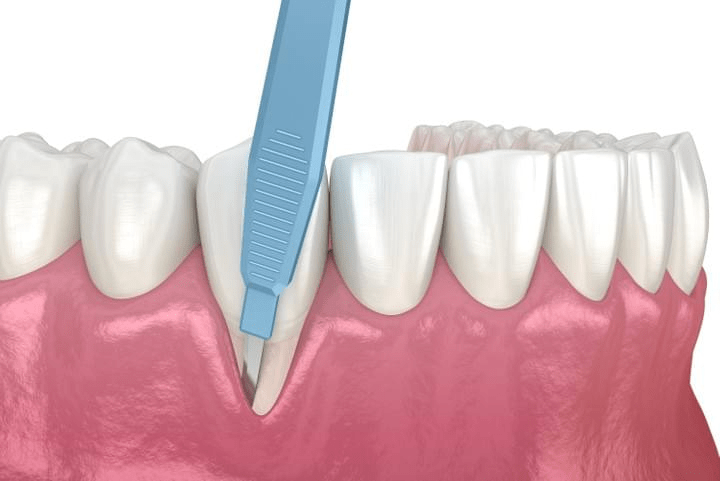 Gum graft procedure - Periodontics Treatments