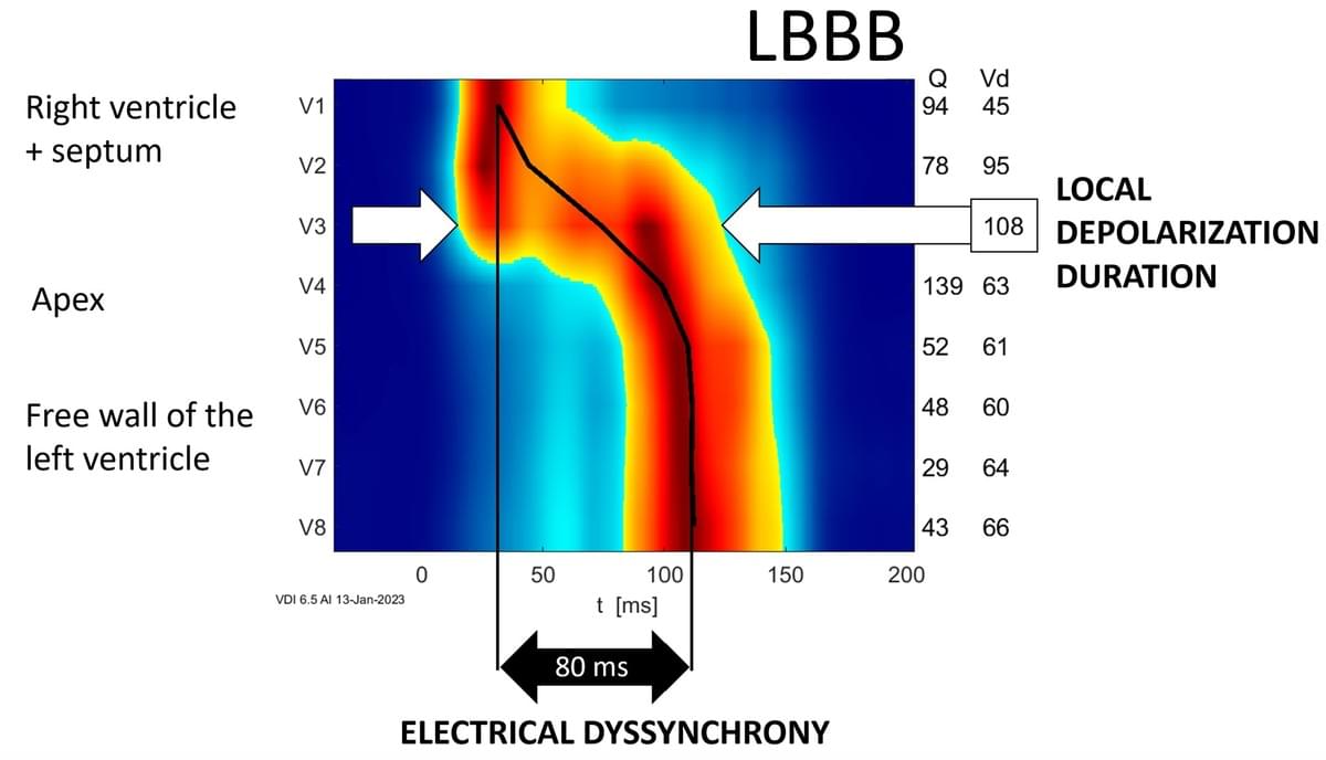 UHF-ECG Mapping - VDI Technologies