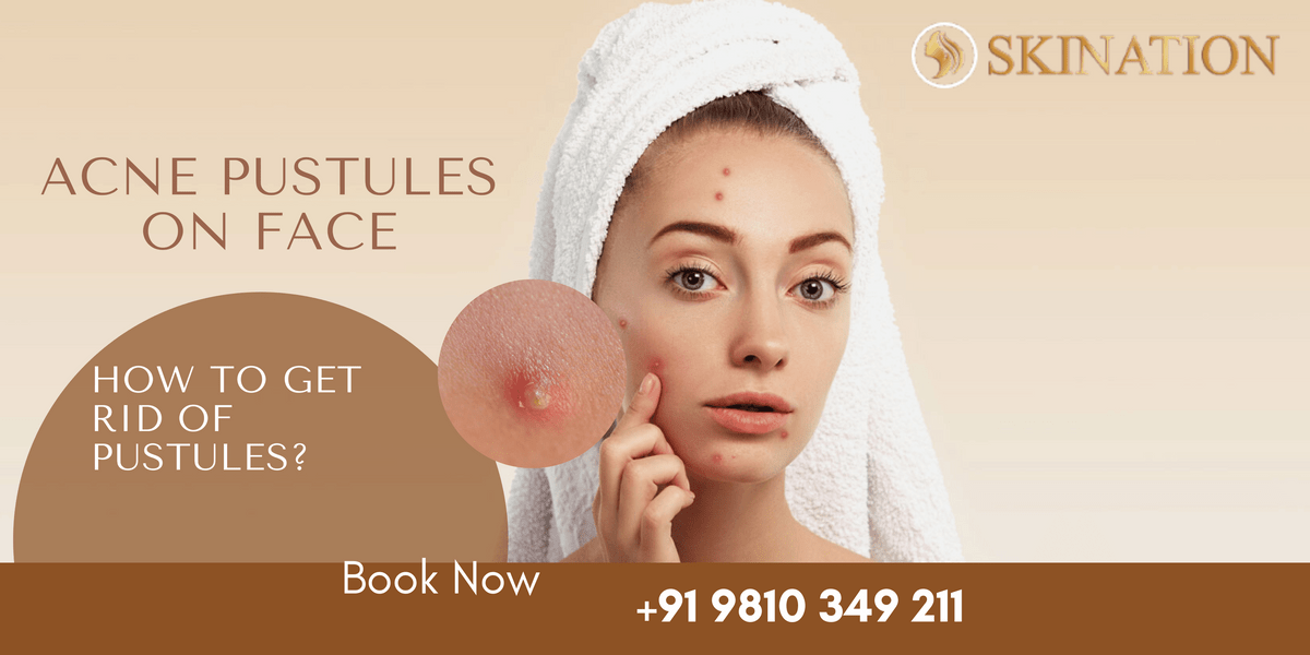 Acne Pustules on Face: How to Get Rid of Pustules? - Ac...