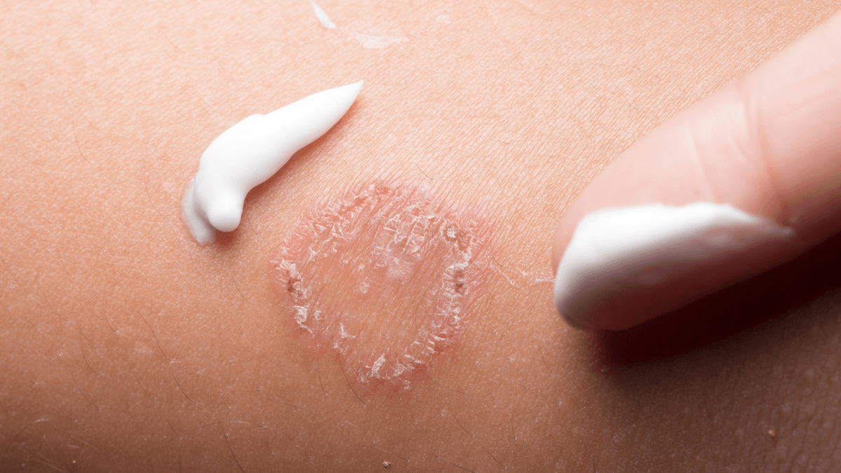 Day 1 Ringworm Pictures: How It Starts and What to Expe...