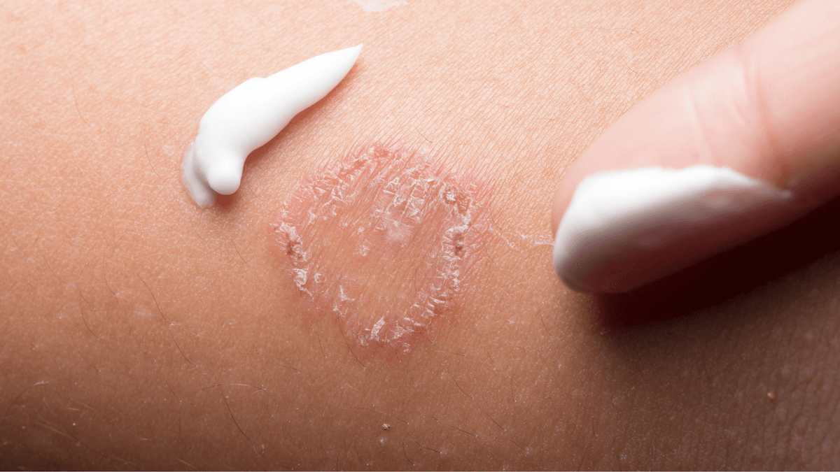 Spotting Ringworm Early: Day 1 Symptoms and Images - he...