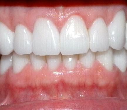 Why Gum Turns White after Whitening?