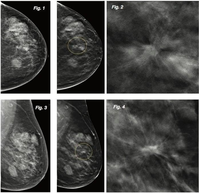 What is 3D mammography?