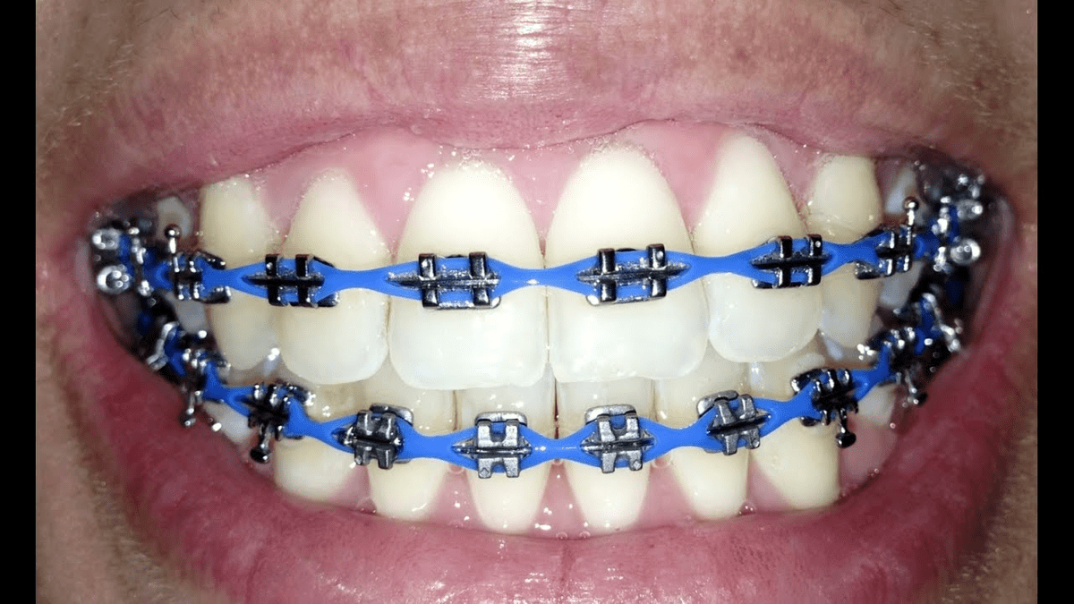 Braces color wheel power chain
