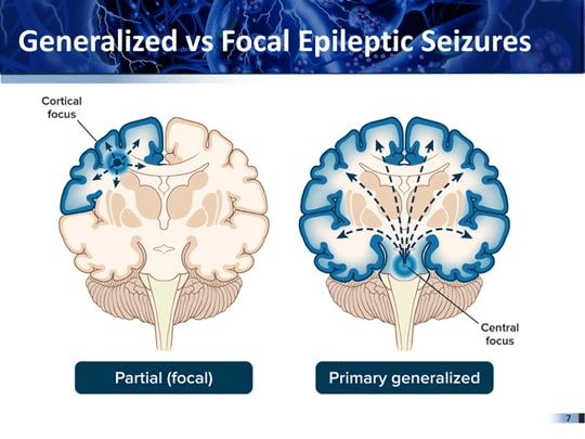 Normal vs epilepsy eeg