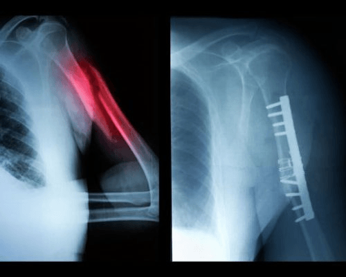 Humerus fracture surgery plate recovery time