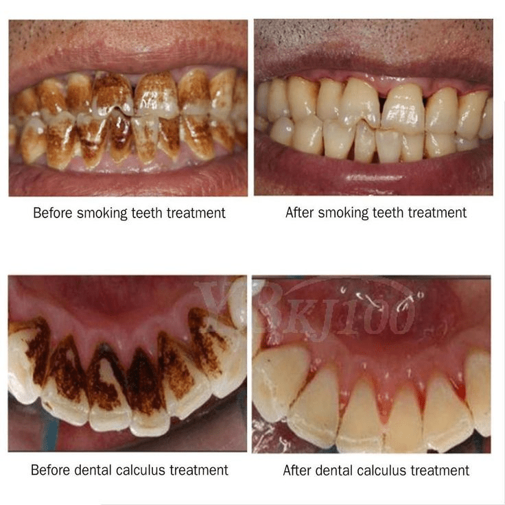 calculus removal dentist