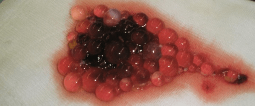 grapefruit sized cyst