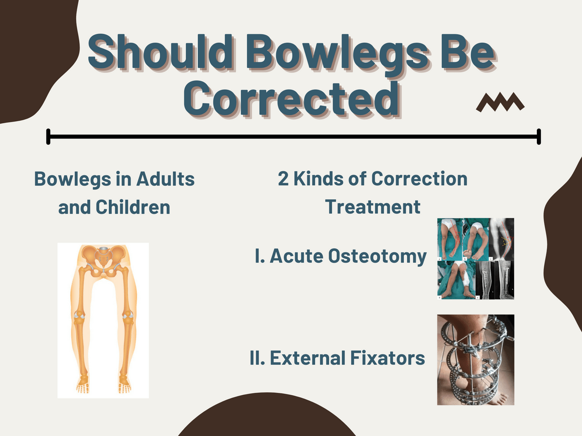 Is it Recommended to Correct Bowlegs - bow-legged treat...