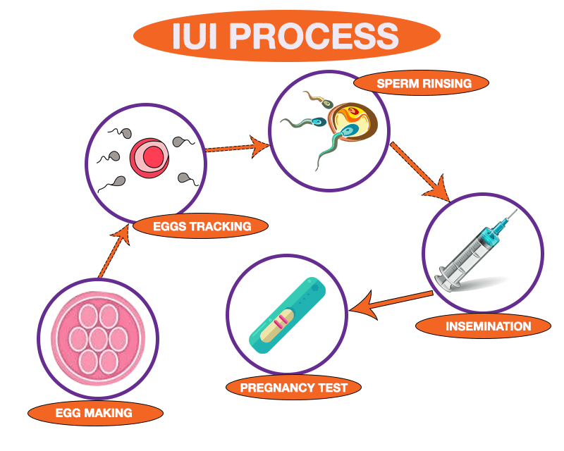 IUI Procedure Step by Step