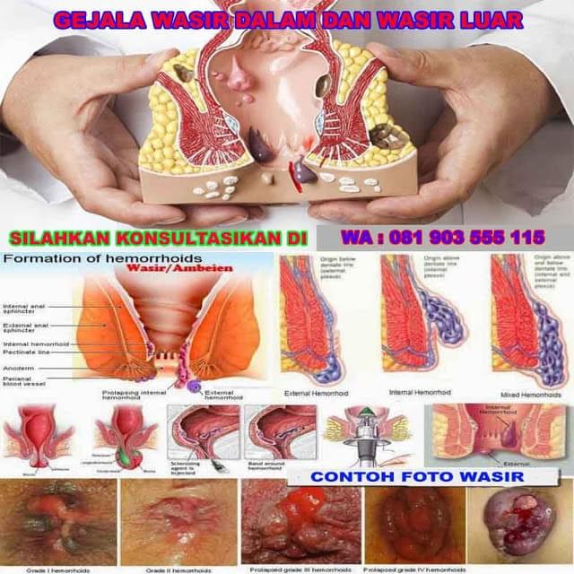 Salep Oles Benjolan Wasir di Apotik Umum Mujarab - Sale...