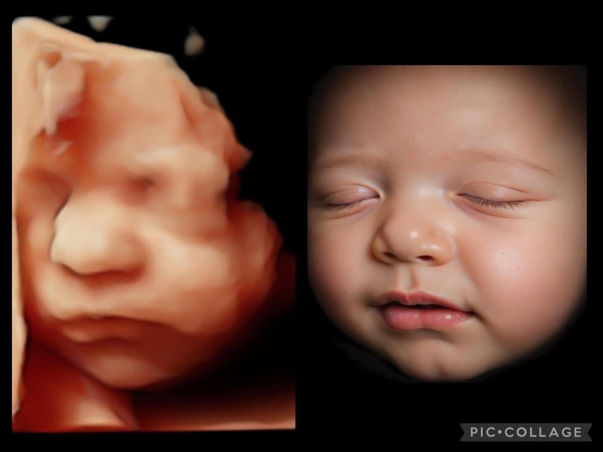Prenatal Imaging 1 3D 4D Ultrasound In Lake Charles LA Prenatal Imaging 1 3D 4D Ultrasound In Lake Charles LA
