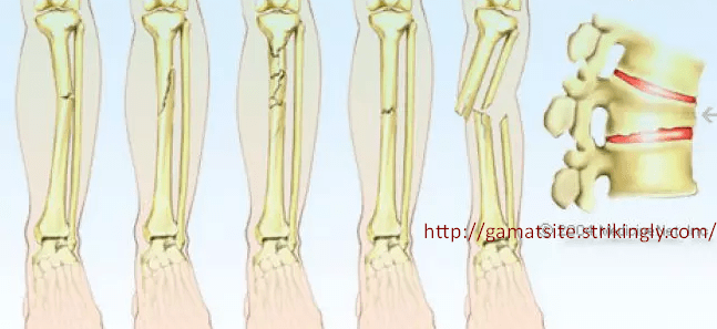 Jenis-Jenis Patah Tulang Dan Cara Untuk Mengobatinya