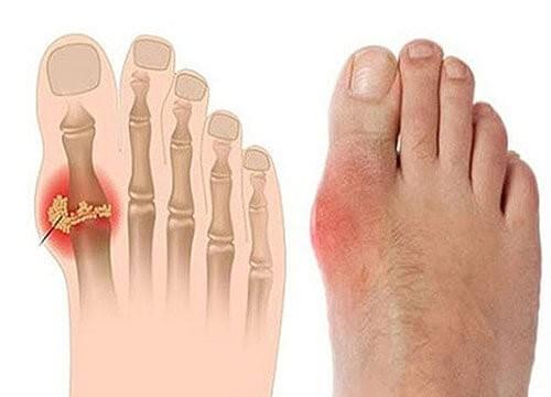 Gout: Nguyên nhân, triệu chứng và điều trị