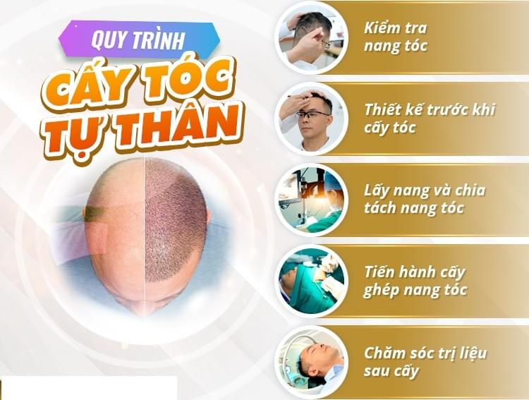 Quy trình cấy tóc trị hói đầu hiệu quả tại Phòng khám C...