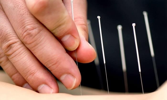 What Happens During an Acupuncture Session? - Videos