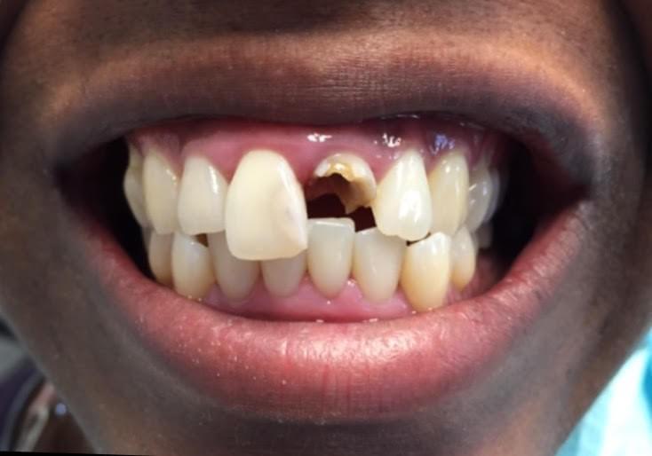 front partial dentures pictures