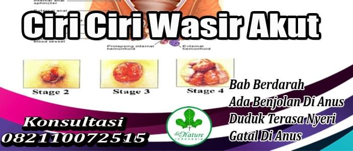 Ciri Ciri Wasir Akut - cara mengobati wasir gejala saki...