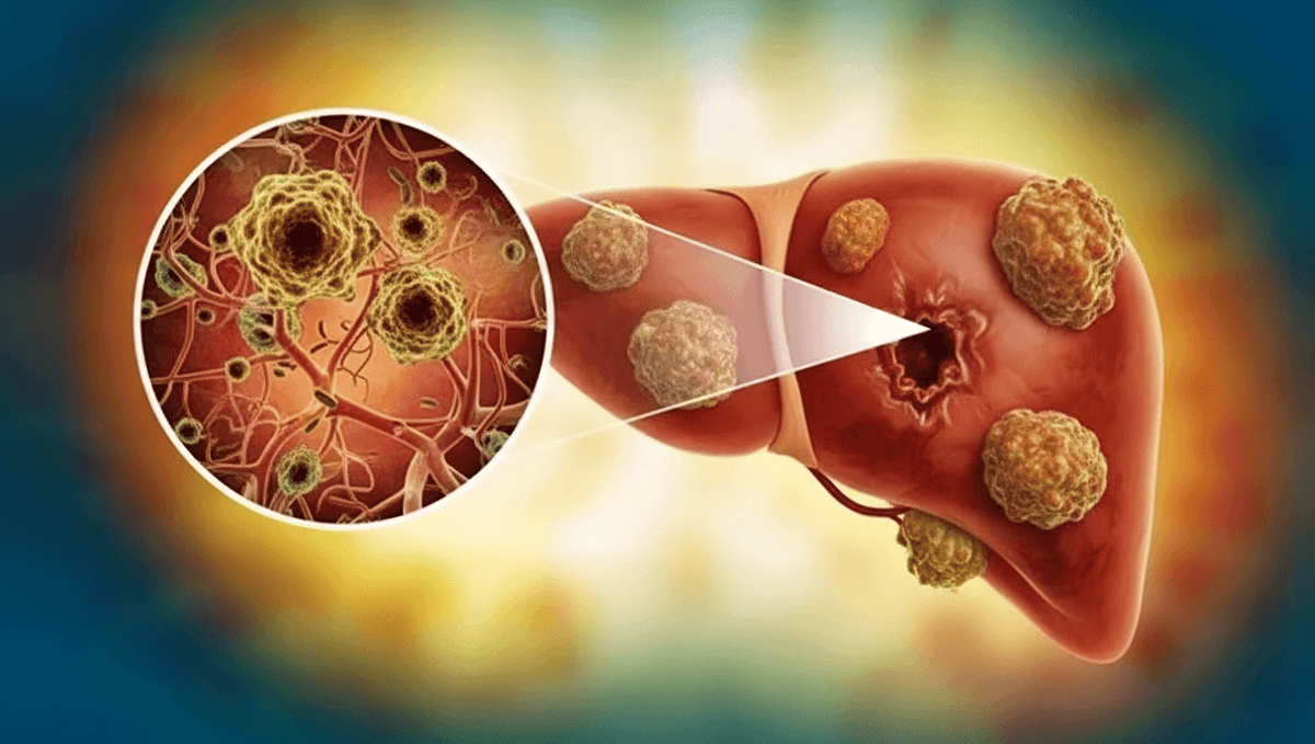 Unraveling the Origins: Who First Identified Liver Canc...