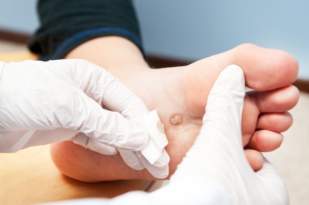 Neuropathic Ulcers - Symptoms, Causes And Treatment - W...