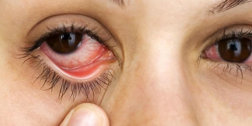 What is Dry Eye Disease? - Eyecare