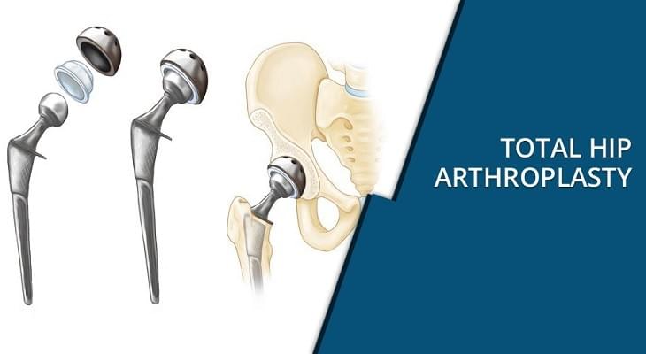 Total Hip Arthroplasty: Indications, Types of Prosthese...
