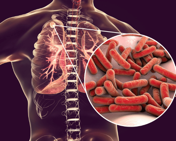 Tuberculosis: Symptoms, Causes and Treatment - health