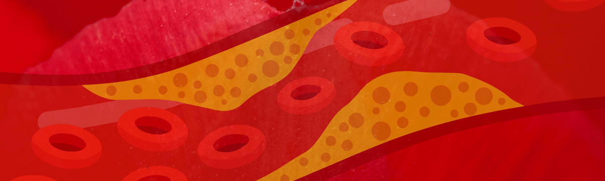 What is Peripheral Artery Disease and Standard Treatmen...