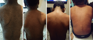 Ichthyosis Cure Tips – Enjoy Strong & Resilient Skin