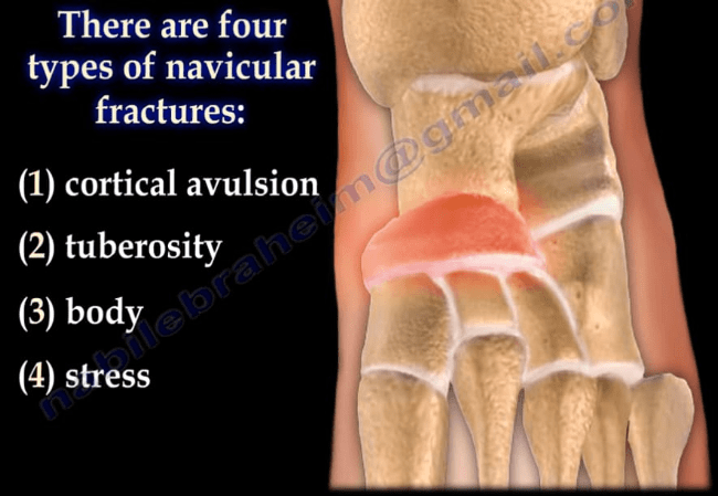 cortex bone fracture