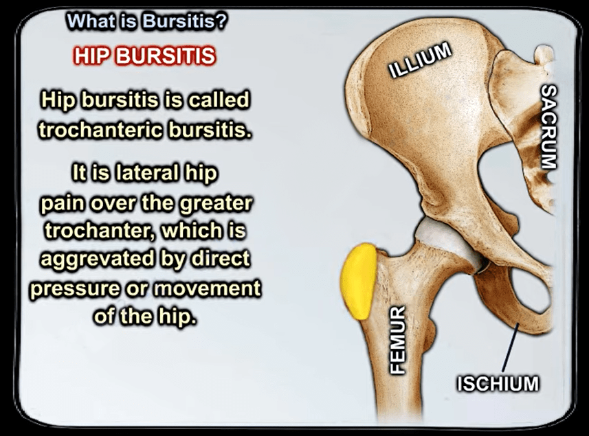 Bursitis of the Knee, Hip, Elbow and Shoulder Everyth...