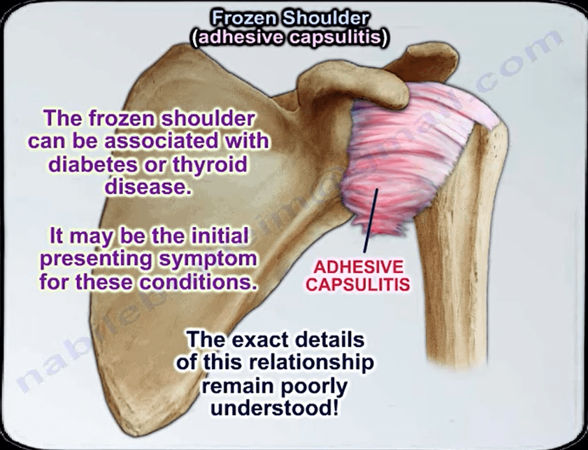 Frozen Shoulder Adhesive Capsulitis